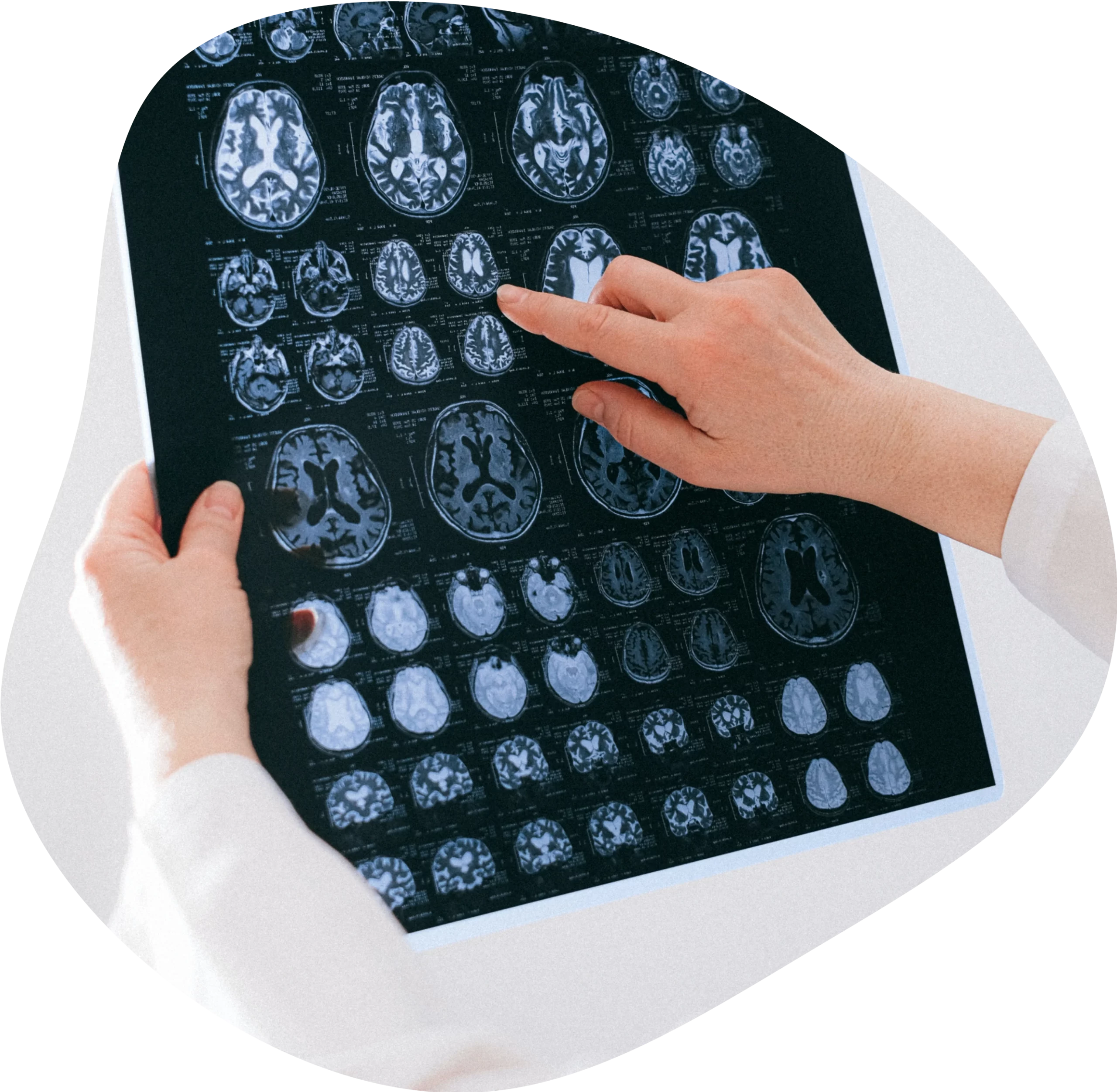 Atelier AVC et bienveillance : agir pour une meilleure inclusion - Synpeak